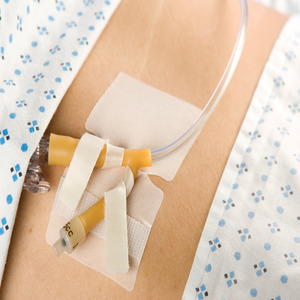 CATH-SECURE Dual Tab Multi-Purpose Tube Anchoring Device - MJ54454 ...